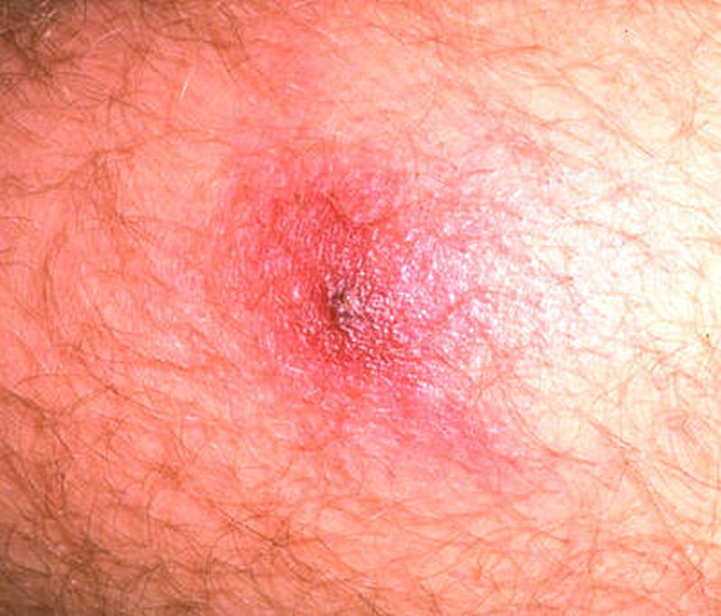 32 year-old man presents with a spider bite