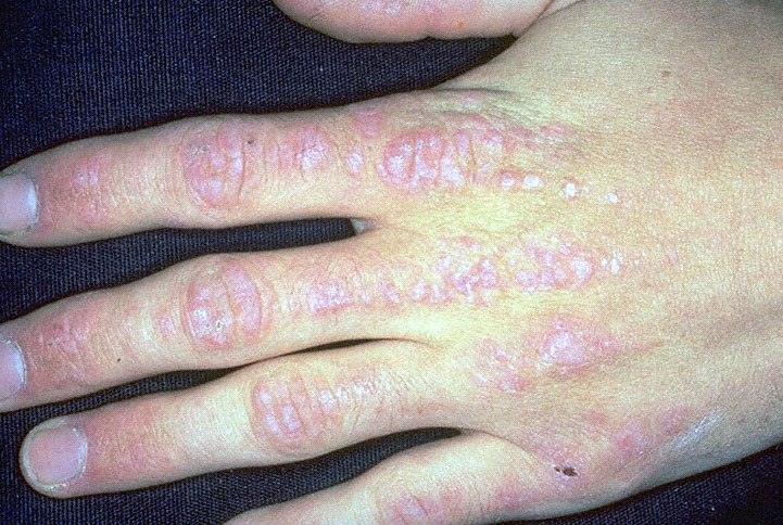 60 year-old female with painless non-pruritic rash